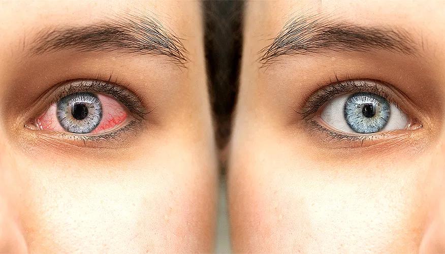 Understanding Gritty Eyes: Causes, Symptoms and Treatments