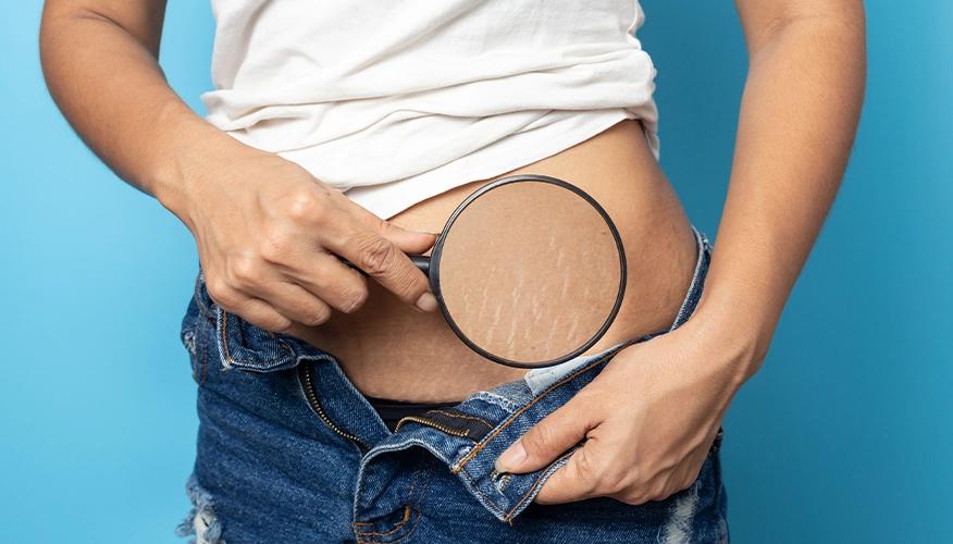 Understanding Pregnancy Stretch Marks: A Complete Overview